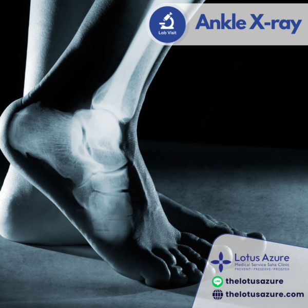 Ankle X-ray (ข้อเท้า) – Lotus Azure